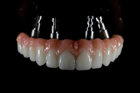 Hybrid Overdentures | Titanium Bars | Prototypes - Digital Dental Lab
