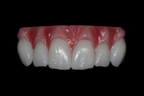 Hybrid Overdentures | Titanium Bars | Prototypes - Digital Dental Lab