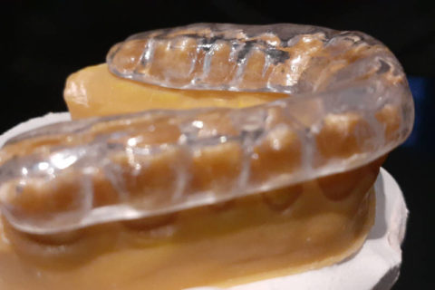 Night Guards - Digital Dental Lab